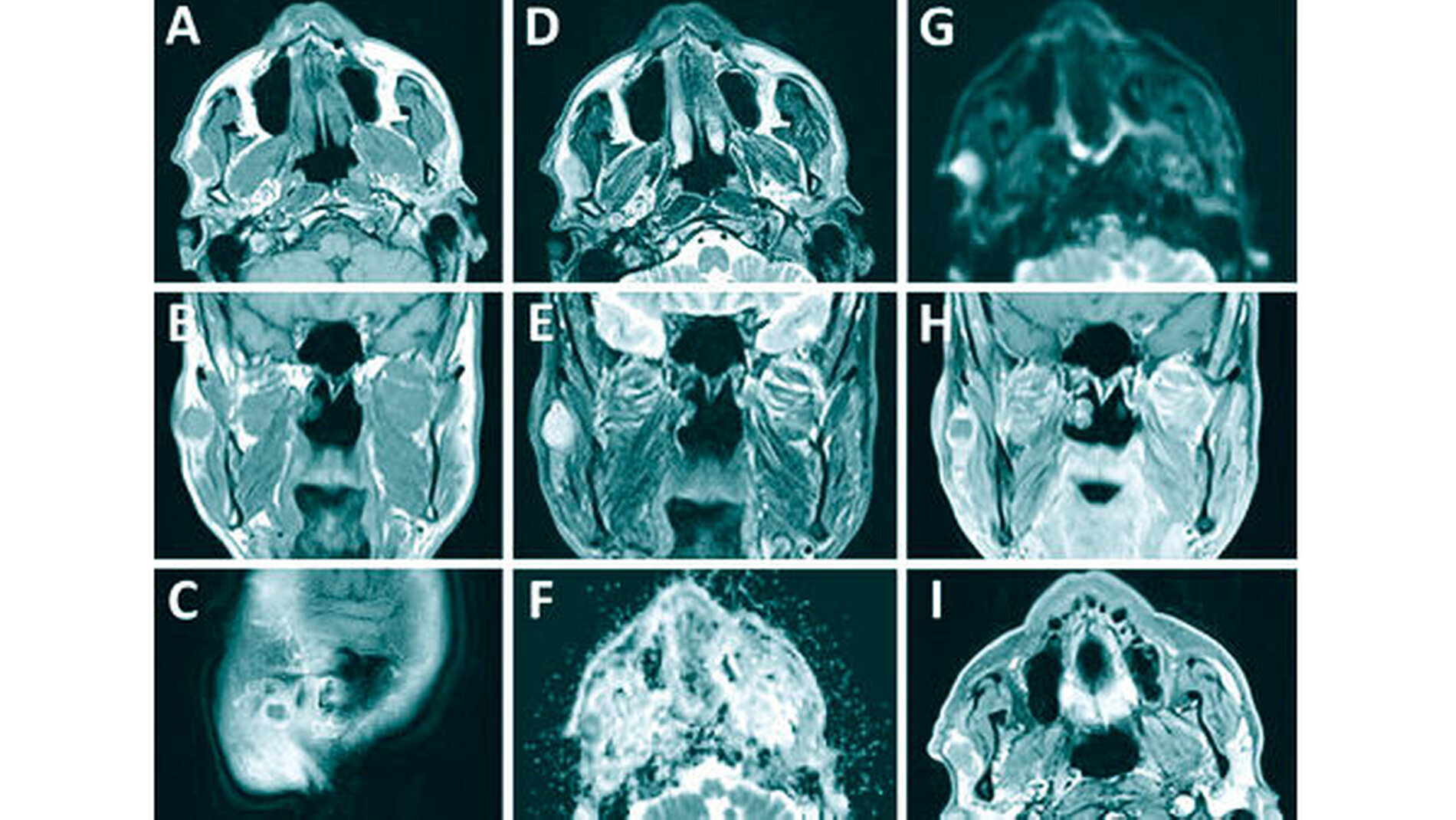 Myoepitheliales Karzinom der Glandula parotis - zm-online