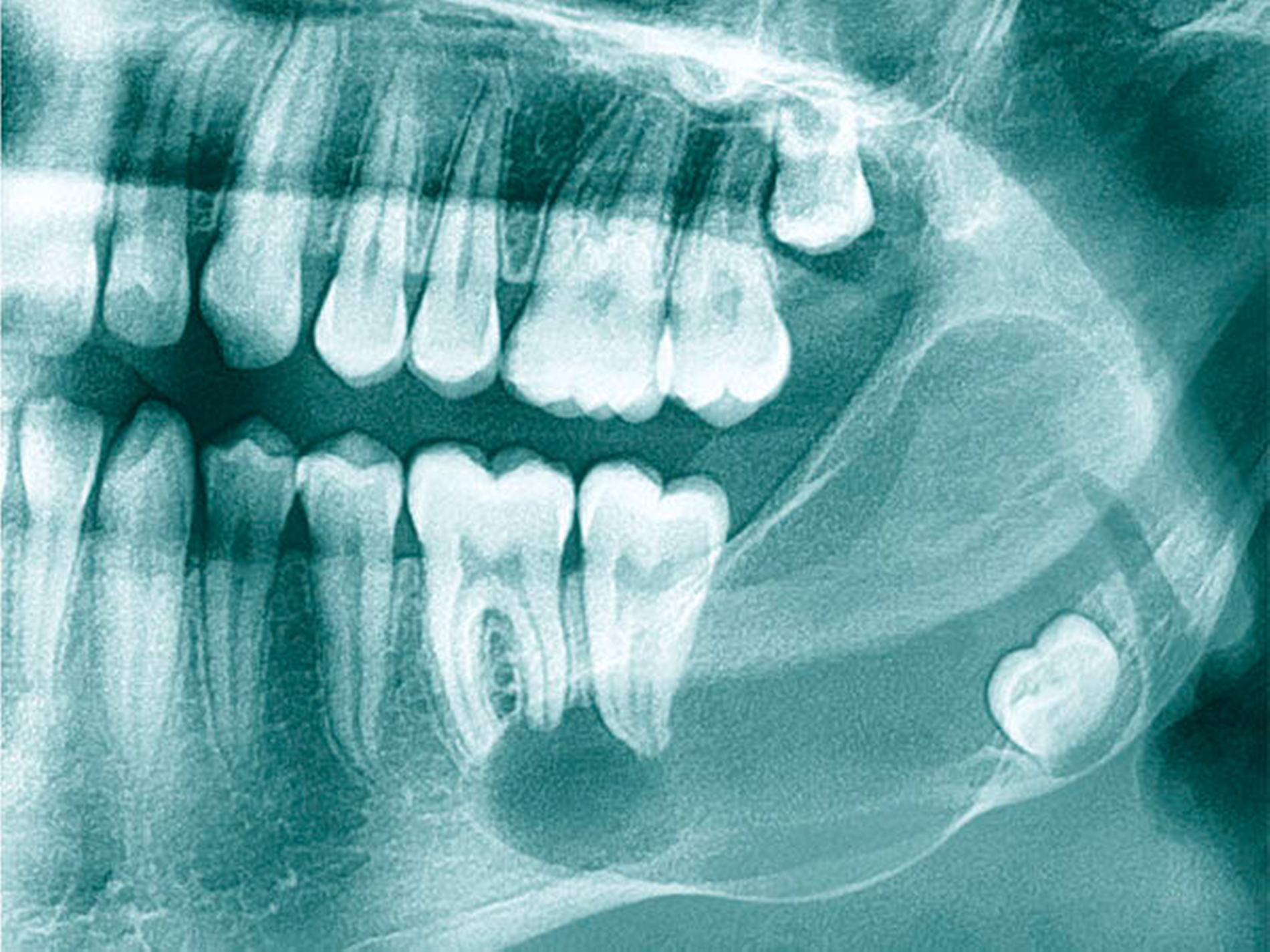Die infizierte odontogene Zyste als diagnostisches Dilemma - zm-online Die infizierte odontogene Zyste als diagnostisches Dilemma - zm-online