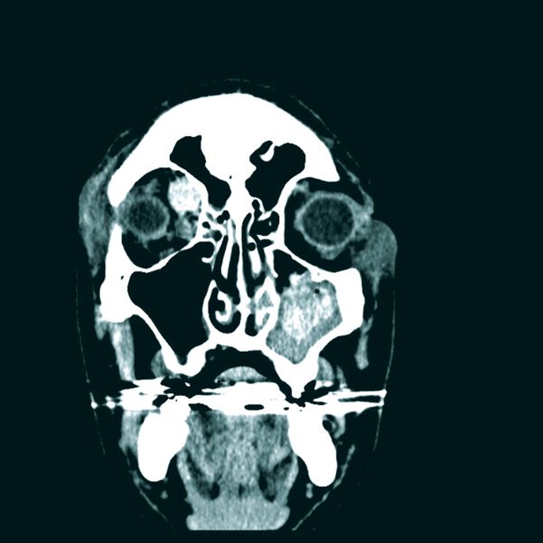 Kompartmentsyndrom der Orbita – Retrobulbärhämatom nach Trauma - zm-online