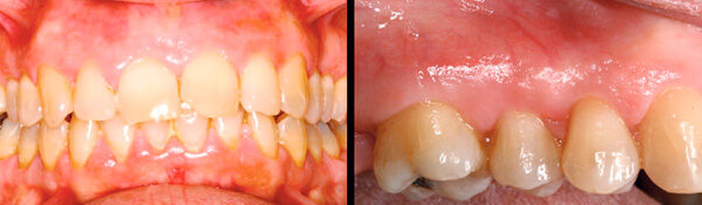 Neue Klassifikation parodontaler und peri-implantärer Erkrankungen und ...