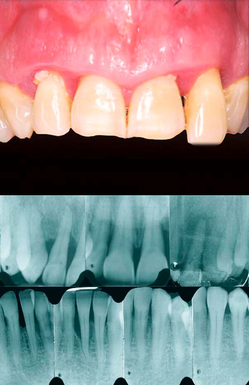 Neue Klassifikation parodontaler und peri-implantärer Erkrankungen und ...