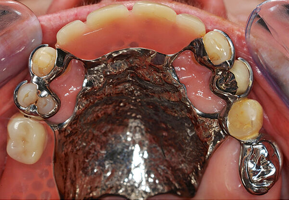 Ästhetikklammern im Frontzahnbereich - zm-online